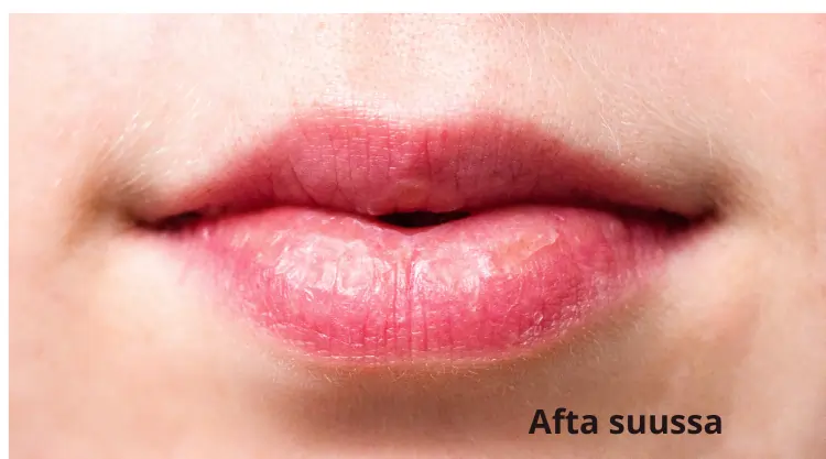 Afta suussa? Opas aftojen hoitoon ja ennaltaehkäisyyn