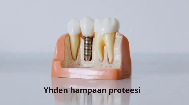 Yhden hampaan proteesi | Saa paras hammasproteesi tarjous